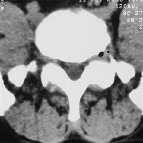 Spinal Ct Scan Axial Showing Foraminal Disk Protrusion With Intradiscal Download Scientific