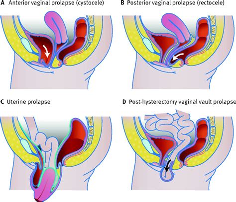 Prolapsed Uterus Stages