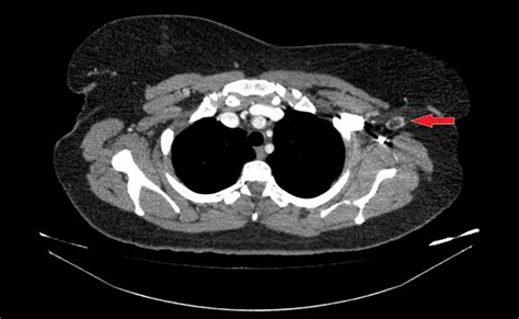The Ct Scan Was Normal Except For The Already Known Adenopathy In Axilla Download Scientific