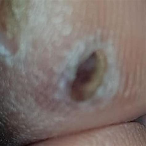 Dfudatasetannotatedinto4classes Kaggle