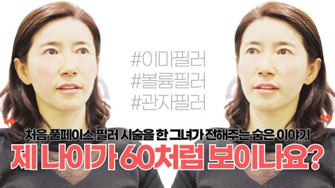 풀페이스 필러 시술 이야기 By 마리의원 도현우 원장 Youtube