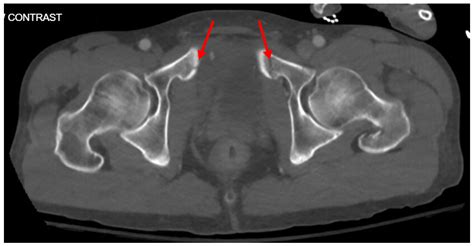 What Causes A Pubic Ramus Fracture