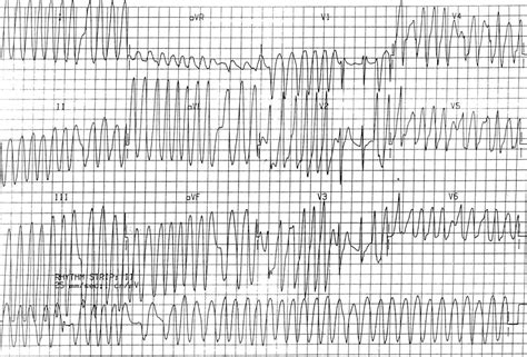 Atrial Fibrillation Flutter In Pre Excitation Litfl Ecg Library 2268