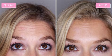 Can You Wear Makeup After Having Botox Bios Pics
