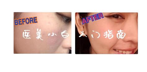 医美小白入门指南，do脸我该怎么选？光子嫩肤、皮秒超皮秒、点阵激光大比拼【光电项目全攻略】 知乎