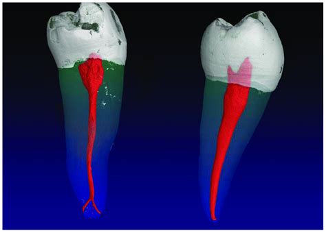Mandibular Second Premolars With A 1 1 12 Rcc Left And An Accessory Download Scientific