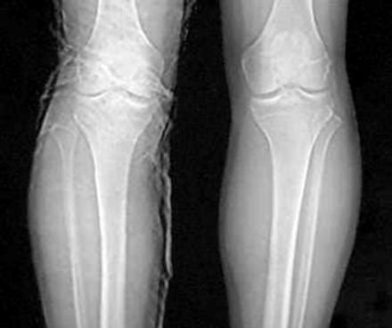 Proximal Tib Fib Dislocation Knee Sports Orthobullets