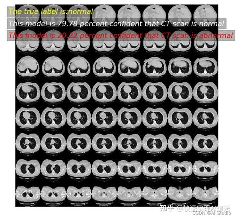 Mosmeddata 新冠肺炎胸部 Ct扫描数据集上基于3d Cnn实现二分类 知乎
