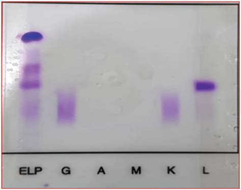 Increased Accumulation Of Lambda Light Chain In The Lambda Zone On Download Scientific Diagram