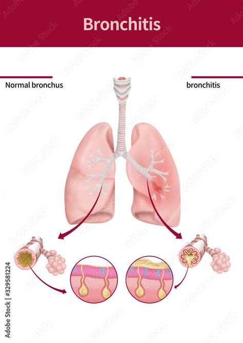 메디컬일러스트 질환 Stock Illustration Adobe Stock