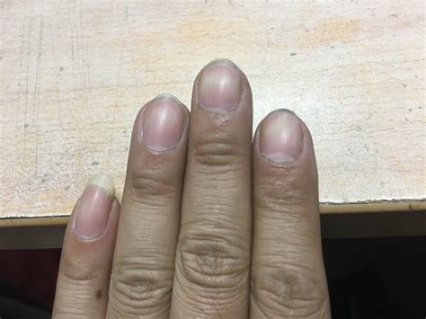 杵状指有什么症状杵状指见于什么病 伤感说说吧