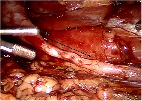 Measurement Of The Length Of Ureteral Stricture As Indicated By The