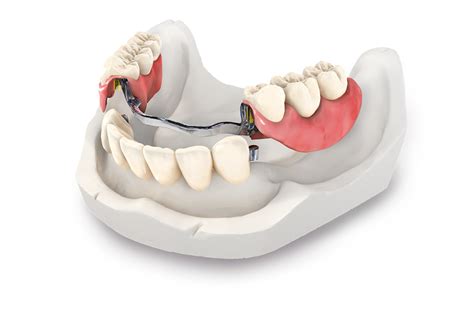 Precision Attachment Partial Denture Creodent