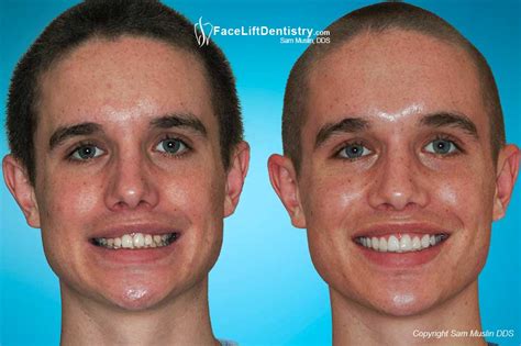 Overbite Correstion Without Braces