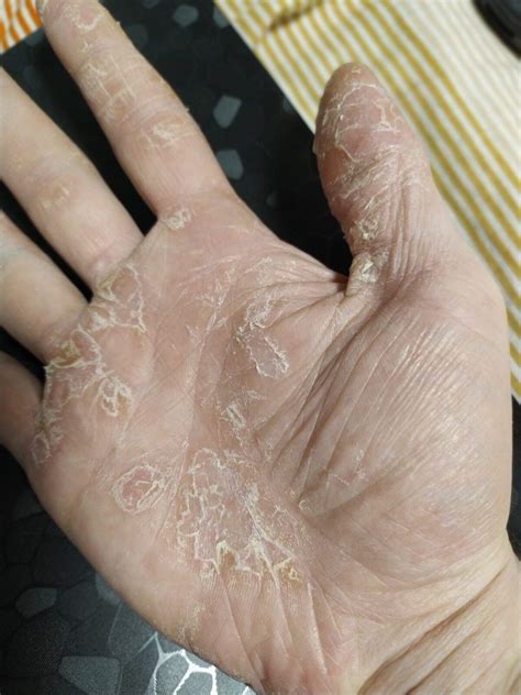 Трескается кожа на пальцах рук причины почему около ногтей портится кожа