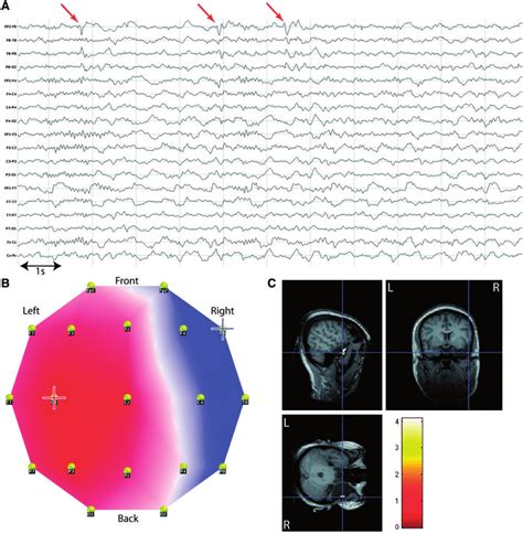 Concordant Results In Medialpolar Temporal Lobe Epilepsy Patient 20