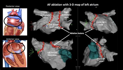 Procedure AF Ablation Melbourne Heart Group