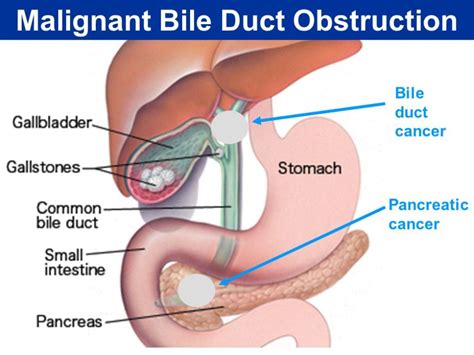 Bile Duct Obstruction Surgery Renew Physical Therapy