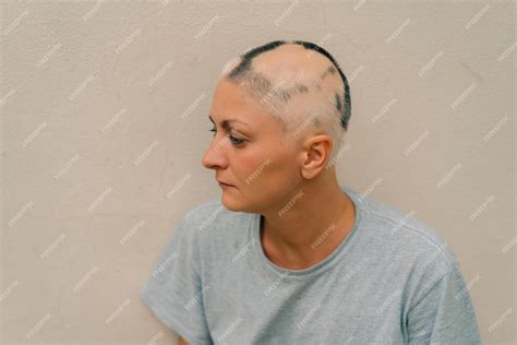 Premium Photo Real Alopecia Areata In A Young Girl A Bald Head In A Person Diffuse Alopecia