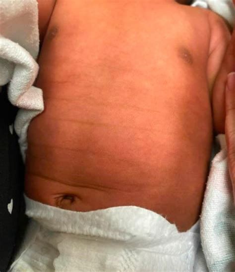 Transient Pigmentary Lines Of The Newborn The Journal Of Pediatrics