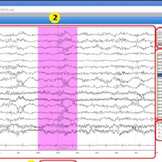 Pseudo Channels Of Phase Reversal Fig Interface Of The EEG Monitor Download Scientific