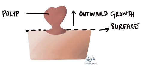 What Is A Polyp Mypathologyreport