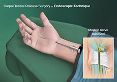 Carpal Tunnel Release Surgery Waukesha Mequon Carpal Tunnel Syndrome
