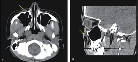 Infraorbital Nerve Mri