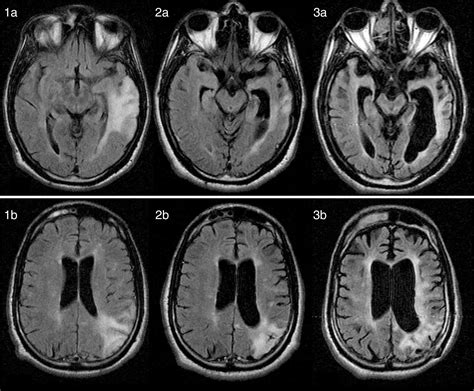 Subacute Sclerosing Panencephalitis