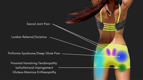 Back Pain Location Chart Understanding Your Pain And Finding The Right