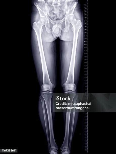 Scanogram Anggota Tubuh Bagian Bawah Atau Gambar Sinarx Dari