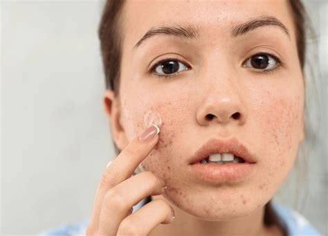When To Use Pimple Patch In Routine