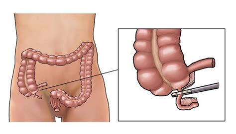 Appendix Surgery In Whitefield Appendix Surgeon In Whitefield