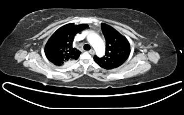 VATS ASSISTED VENOUS ACCESS PORT CATHETER REPOSITIONING OF AN INADVERTENTLY PUNCTURED SVC