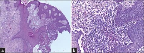 Pyodermatitis Pyostomatitis Vegetans With Penile Ulceration Complicated