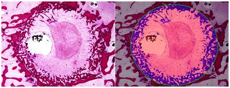 histomorphometric quantification of new bone within defect boundary at