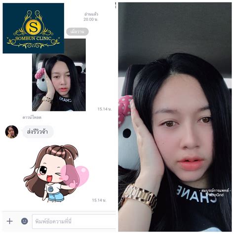 💋ปากกระจับโปรโมชั่นเพีย Sb Clinic สมบูรณ์การแพทย์ ขอนแก่น