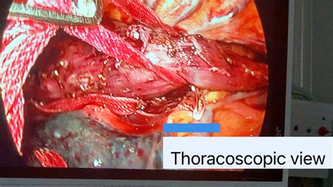 Dr Nandan Ashok On Linkedin Esophageal Cancer At 25 Cms Procedure Thoracoscopic Laparoscopic…