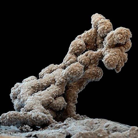 Teratoma Cancer Cells Photograph By Juergen Berger Fine Art America