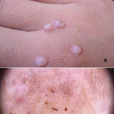 A Condyloma Acuminatum Papules And Plaques Vegetating