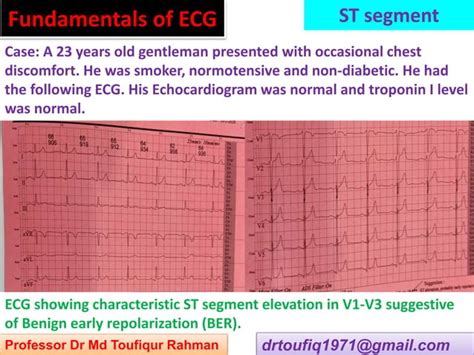 Approach To A Patient With St Segment Abnormality In Ecg Ppt