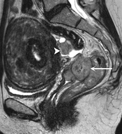 Mr Imaging Features Of Vaginal Malignancies Radiographics