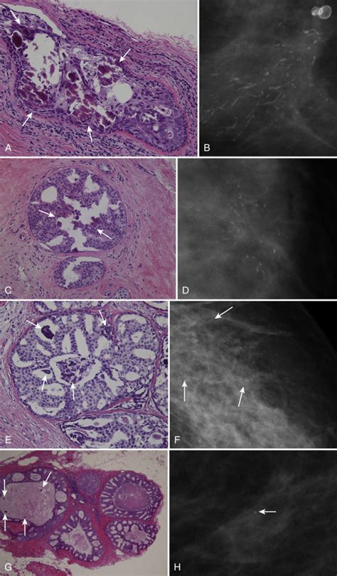 Mammographic Analysis Of Breast Calcifications Clinical Tree