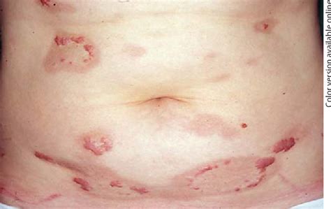 Figure 1 From Nodular Morphea Semantic Scholar