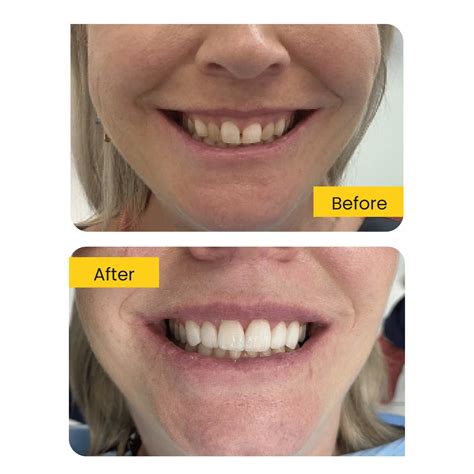 Teeth Aligning Campaign Infinity Dental Clinic