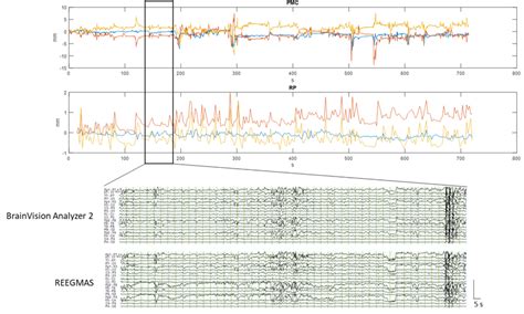 Example Of Eeg Correction From Patient 2 Run 2 Brain Vision Analyzer