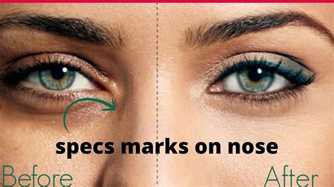 Remove Spectacle Marks On Nose And Under Eye Nose Pe Black Line Hataye Simple Tips Priya Sana