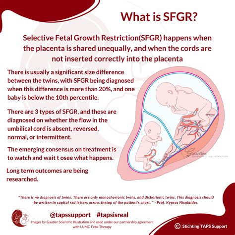 Pin On Types Of Twins