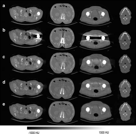 Representative Examples Of Metal Artefacts Simulation And Correction Download Scientific