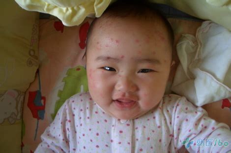 宝宝喉咙泡疹的图片 婴儿喉咙有泡疹图片 孩子喉咙有泡疹 第11页 大山谷图库